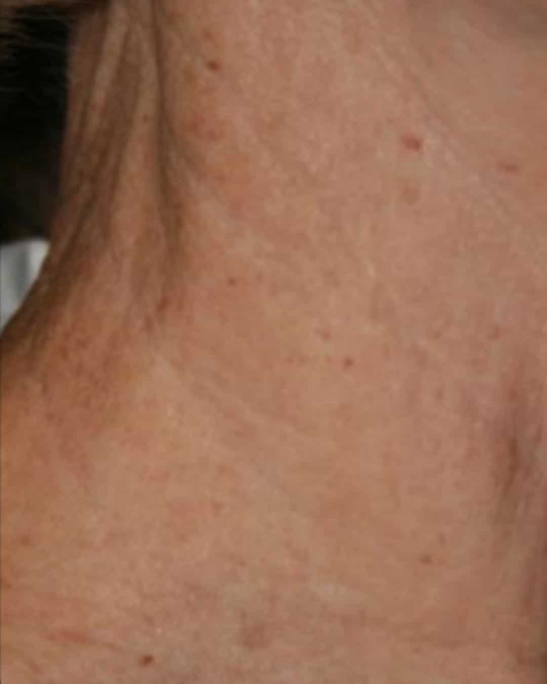 CO₂ Laser Milwaukee | EvolvMD MedSpa– Skin Resurfacing