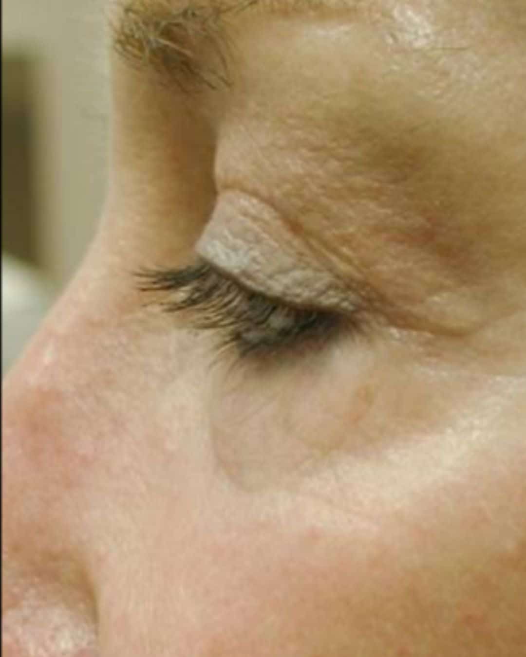CO₂ Laser Milwaukee | EvolvMD MedSpa– Skin Resurfacing