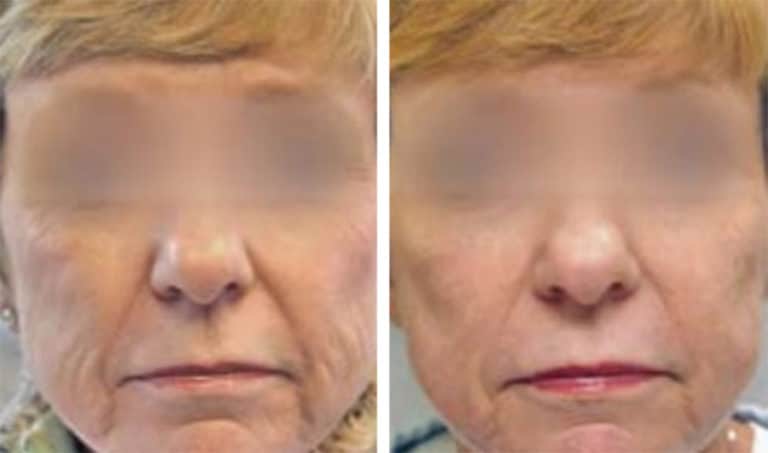 Fractional Laser Skin Resurfacing at EvolvMD Medical Spa, Milwaukee WI