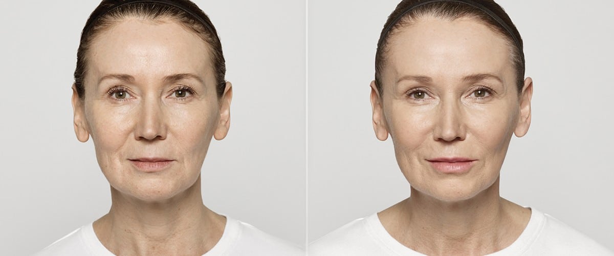 Restylane Lyft Treatments in Milwaukee, WI | EvolvMD